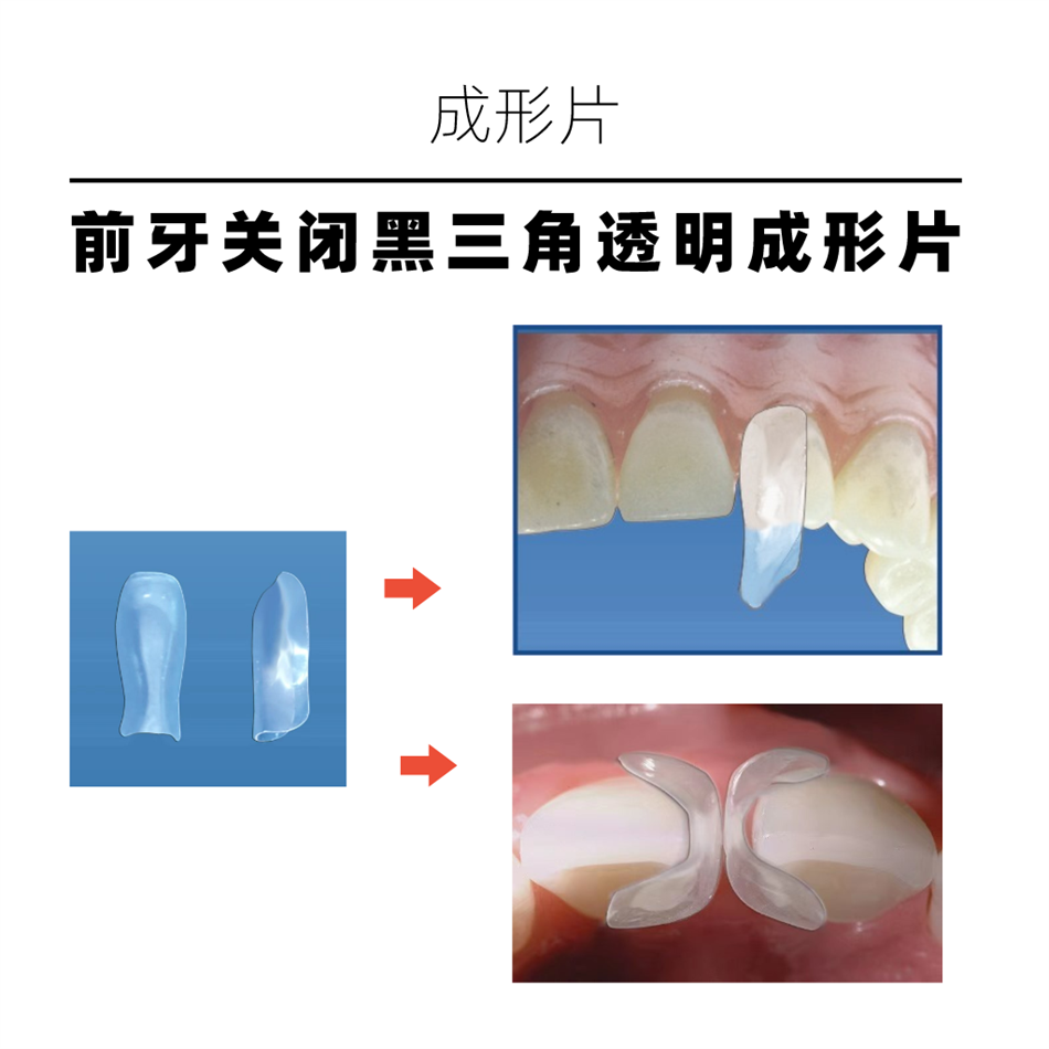 俄罗斯/TORVM拓维亚 前牙黑三角透明成形片 1.908,中号,5片/盒