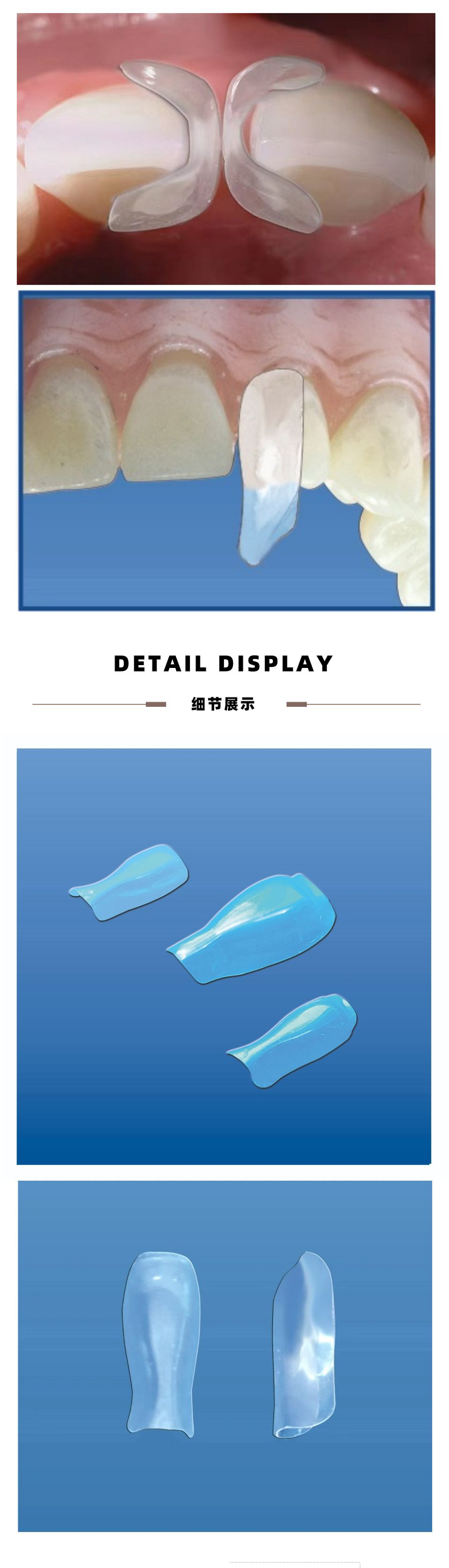 俄罗斯/TORVM拓维亚 前牙黑三角透明成形片 1.908,中号,5片/盒